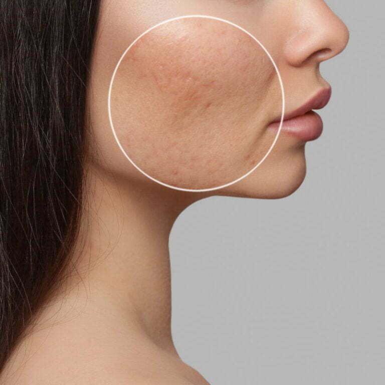Acne Scarring • MeadowView Aesthetics Skin Clinic and Laser Specialist